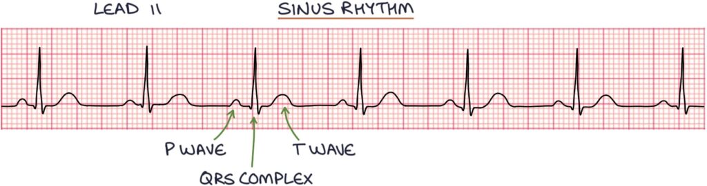 ECG Basics and Sinus Rhythm – Zero To Finals