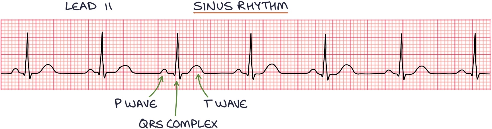 ECG Basics and Sinus Rhythm – Zero To Finals
