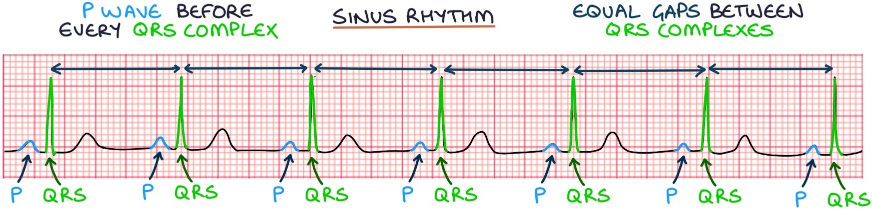 Atrial Fibrillation – Zero To Finals