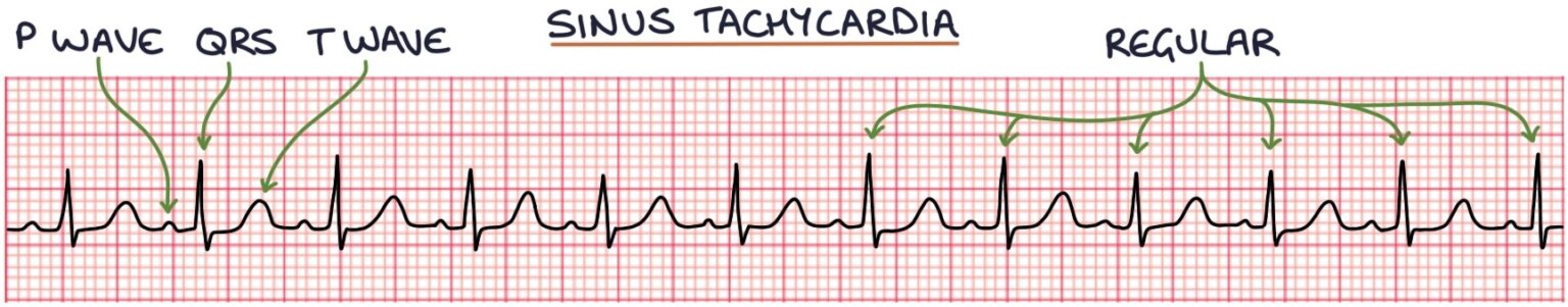 Supraventricular Tachycardia – Zero To Finals