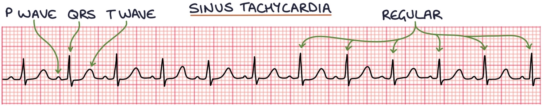 Supraventricular Tachycardia – Zero To Finals