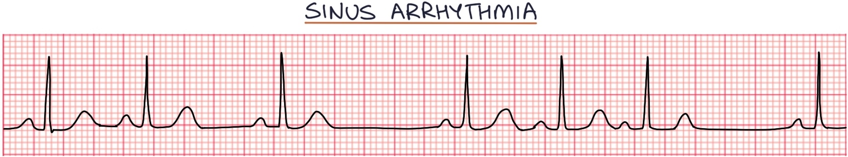Arrhythmias – Zero To Finals