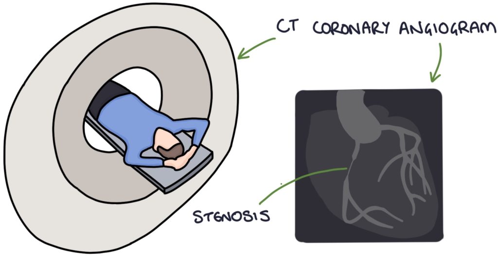 Stable Angina – Zero To Finals