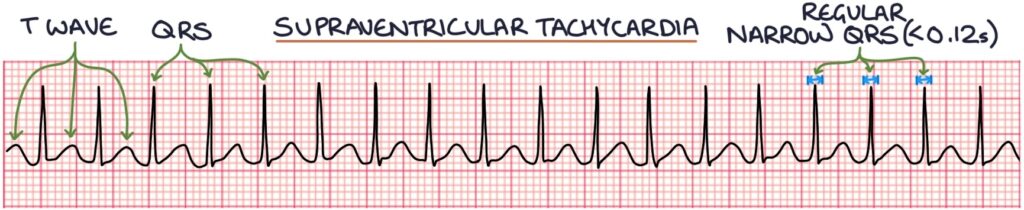 Supraventricular Tachycardia – Zero To Finals