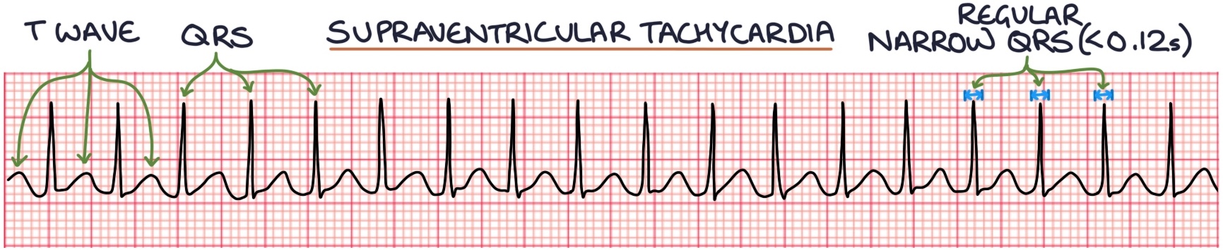 Supraventricular Tachycardia – Zero To Finals