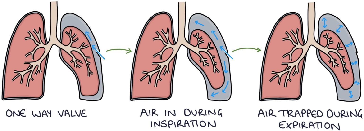 Pneumothorax – Zero To Finals