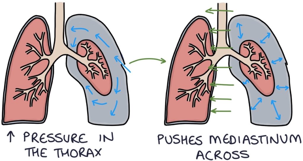 Pneumothorax – Zero To Finals