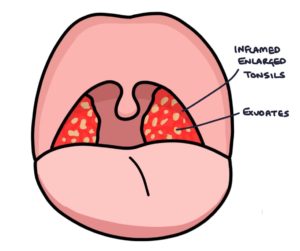 Tonsillitis – Zero To Finals