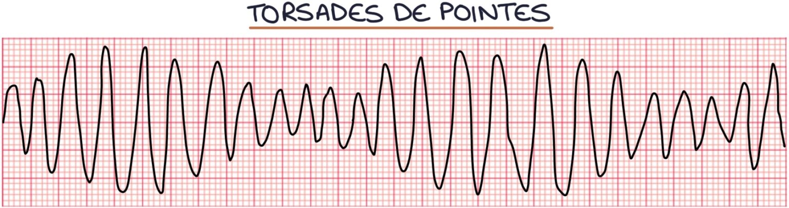ECG Basics and Sinus Rhythm – Zero To Finals