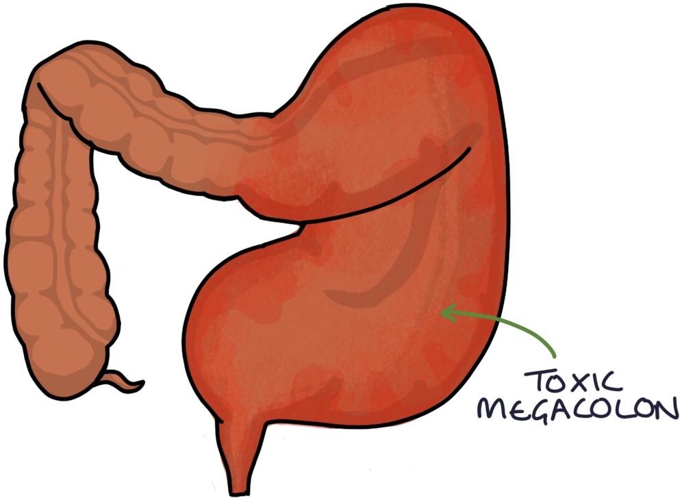 Clostridium Difficile – Zero To Finals