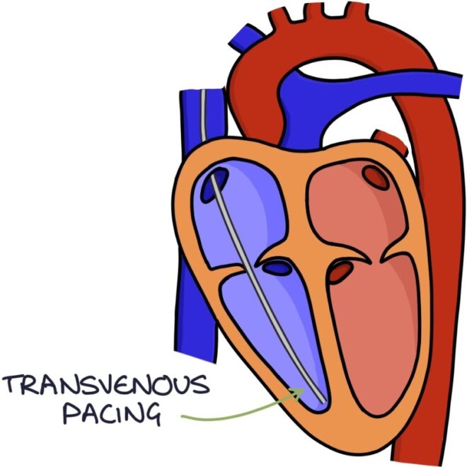 Arrhythmias – Zero To Finals