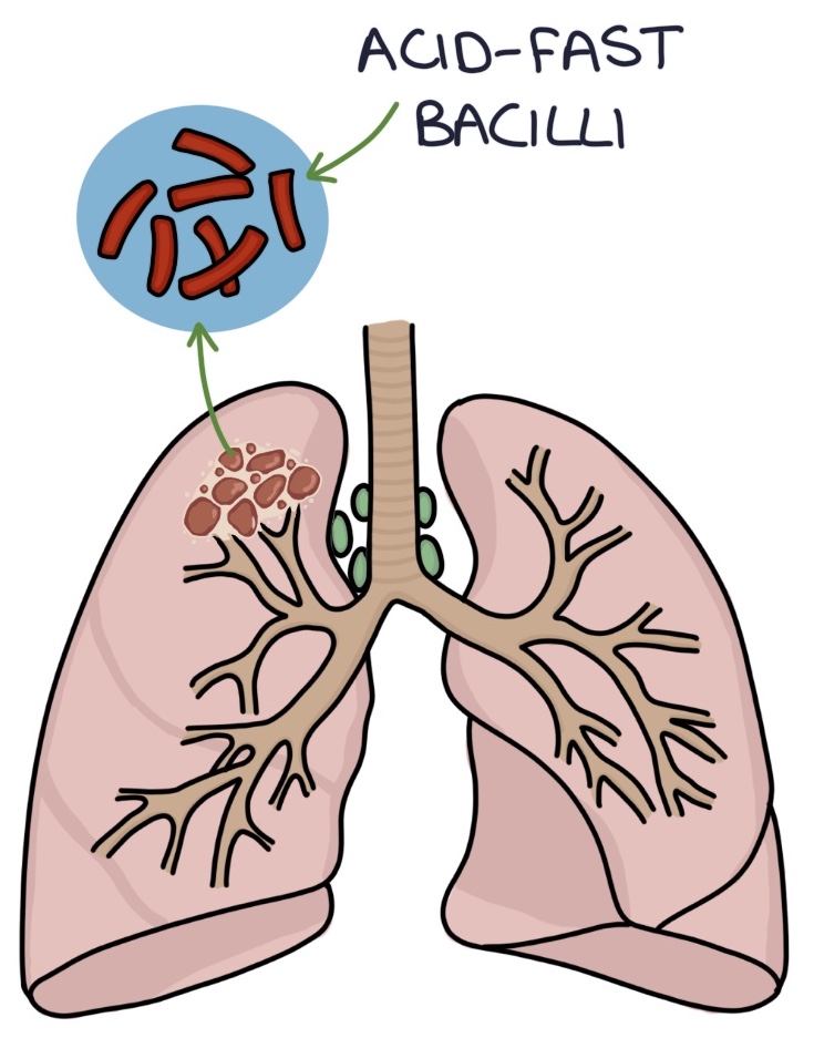 Tuberculosis – Zero To Finals