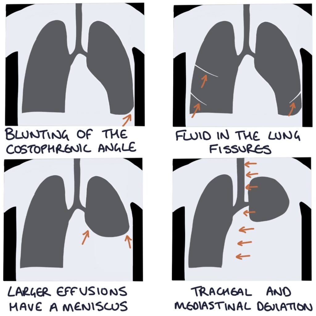 Pleural Effusion – Zero To Finals