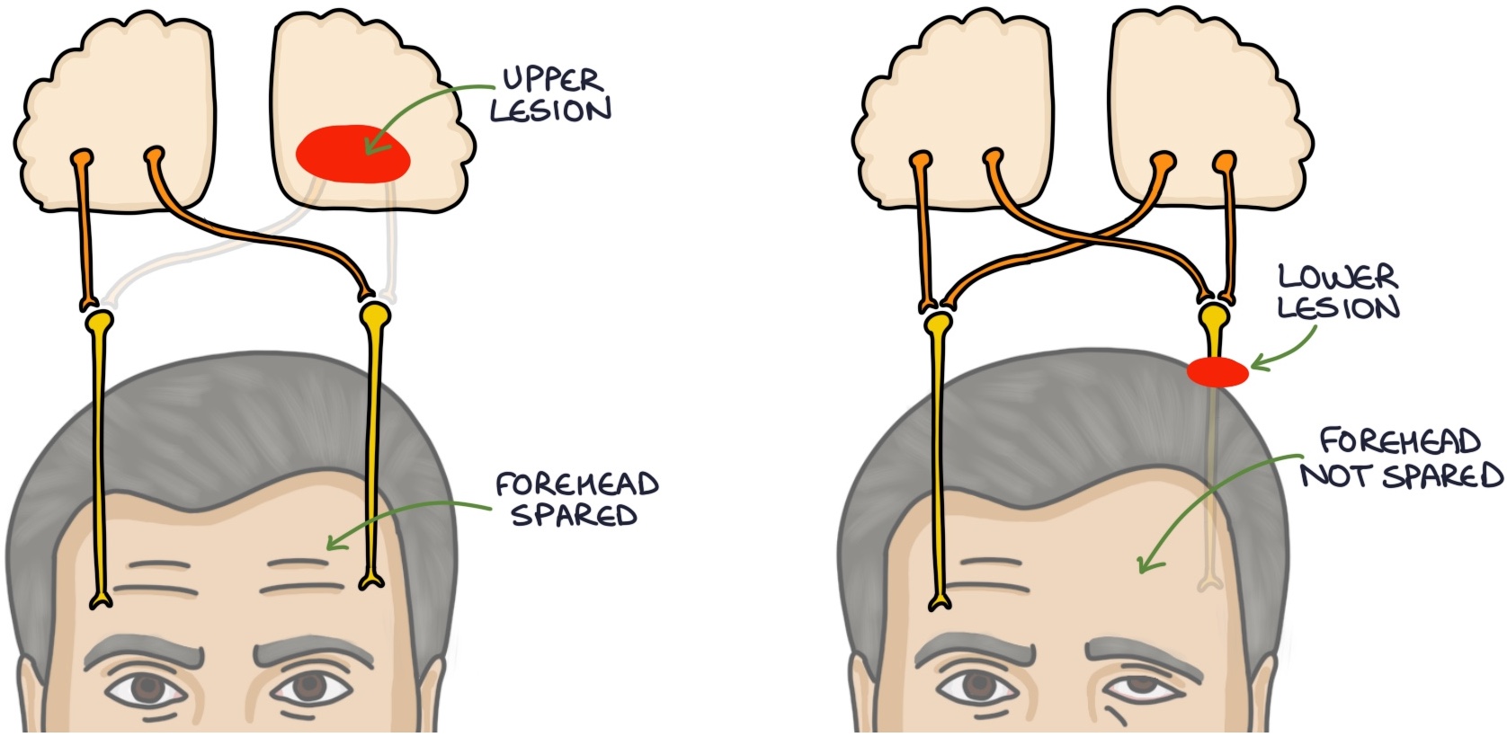 Facial Nerve Palsy – Zero To Finals