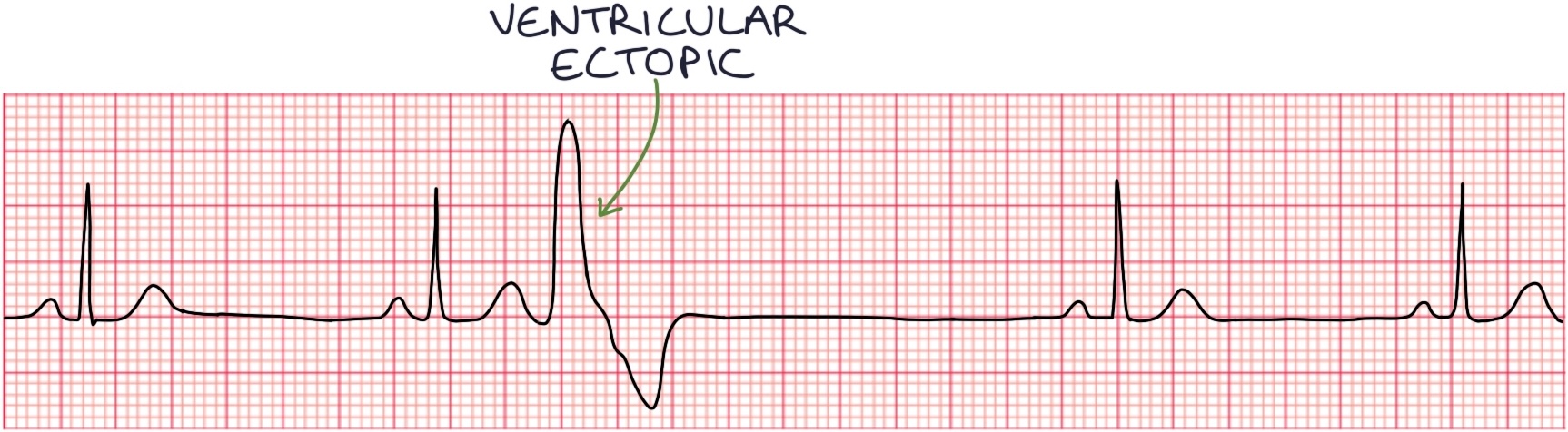 Arrhythmias – Zero To Finals