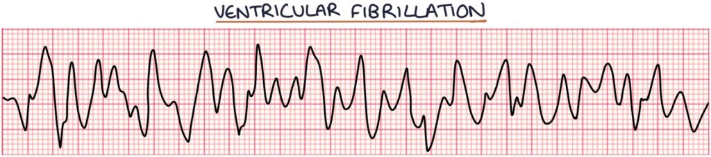 Arrhythmias – Zero To Finals