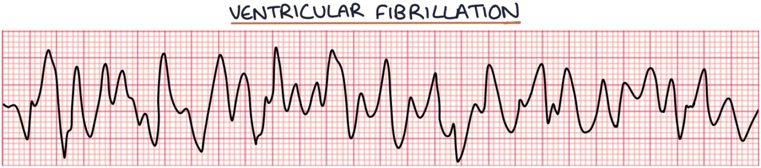 Arrhythmias – Zero To Finals