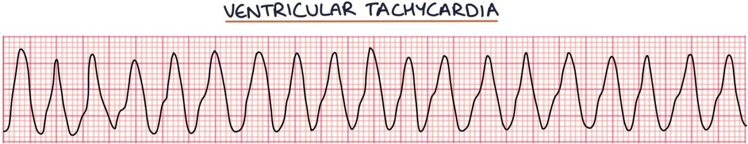 Arrhythmias – Zero To Finals