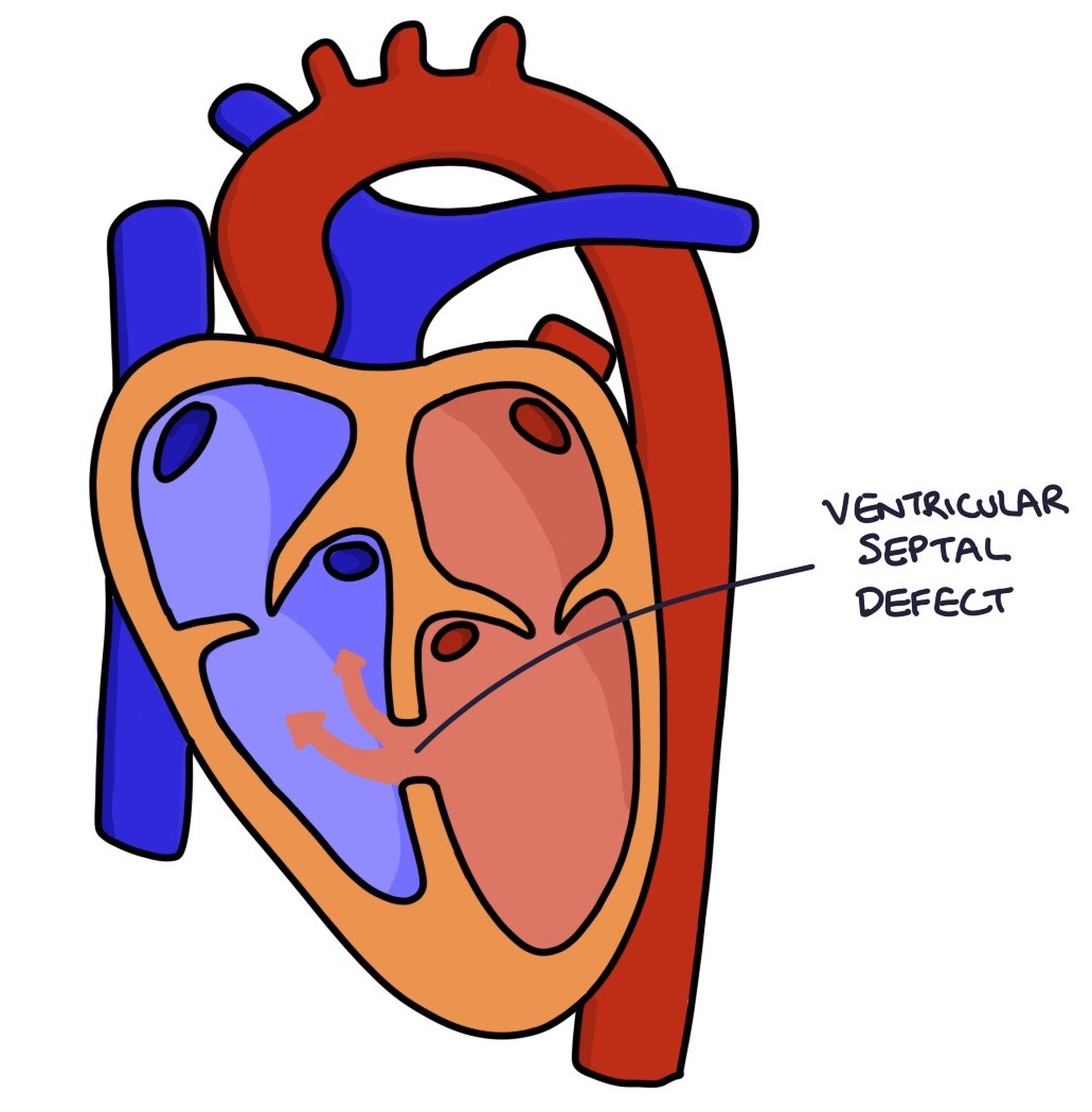 Congenital Cardiac Conditions – Zero To Finals