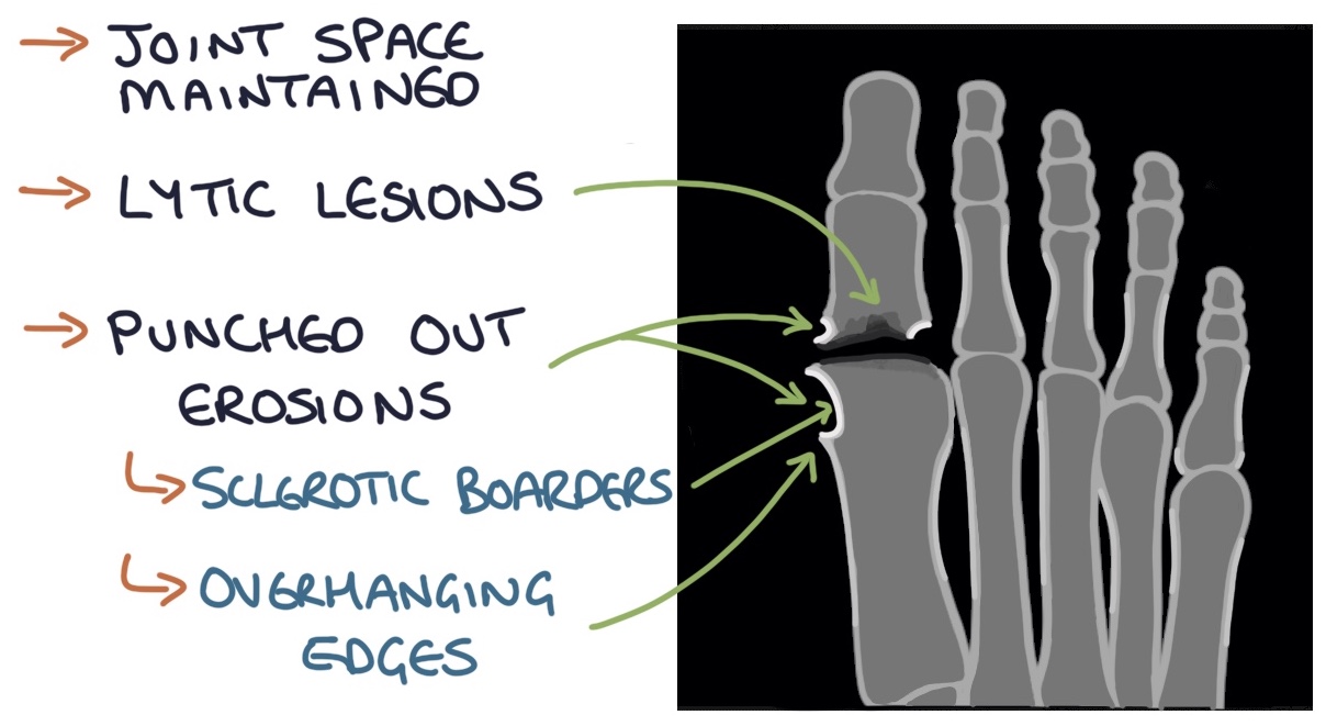 Gout – Zero To Finals