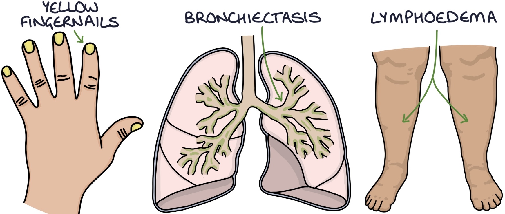 Bronchiectasis – Zero To Finals
