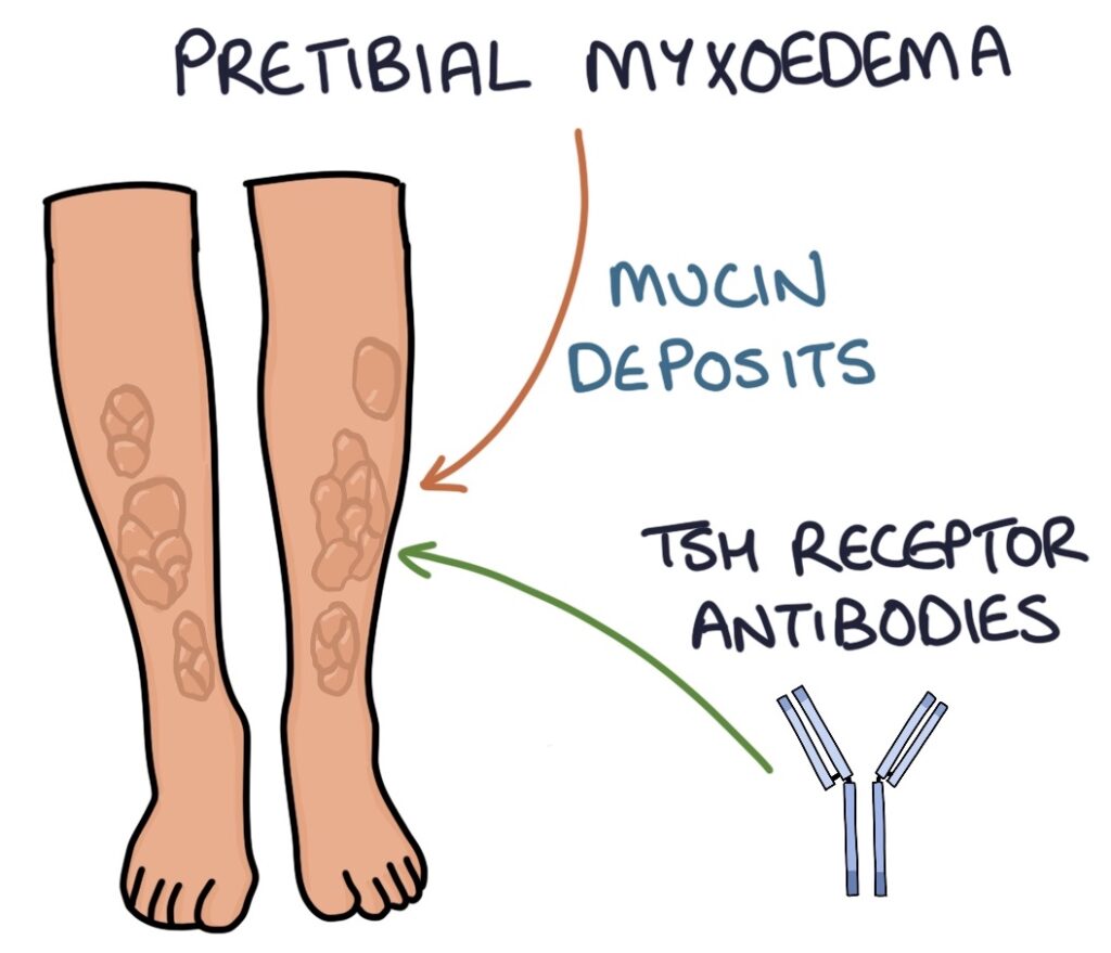 Hyperthyroidism – Zero To Finals