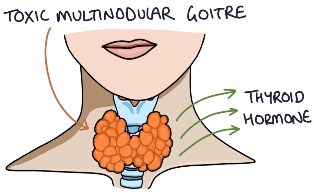 Hyperthyroidism – Zero To Finals