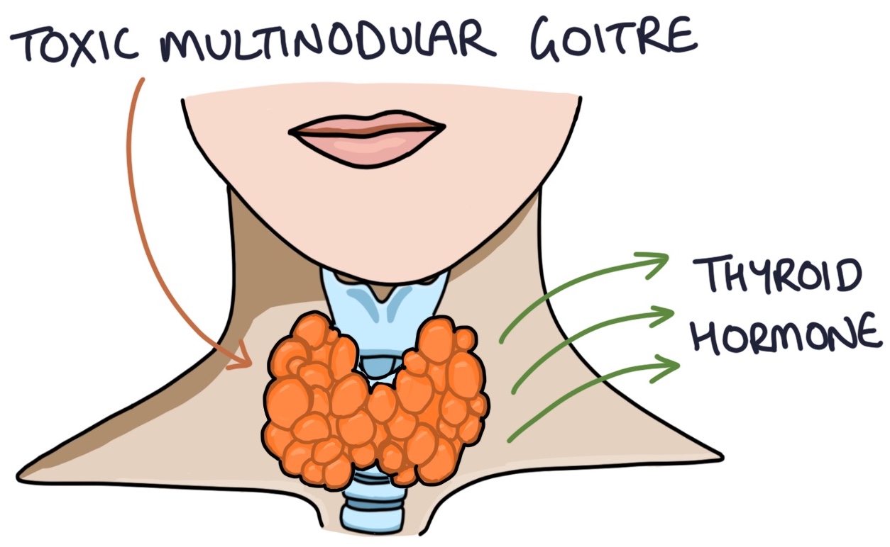 Hyperthyroidism – Zero To Finals
